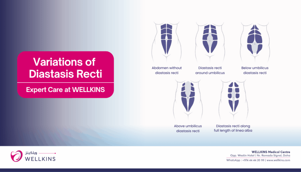 How Physiotherapy Tackles Diastasis Recti in Qatar | wellkins